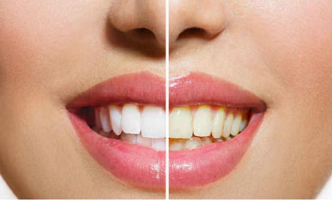 DIY TEETH BRIGHTEN TIPS TO FOLLOW BEFORE GETTING MARRIED - Fashion ...